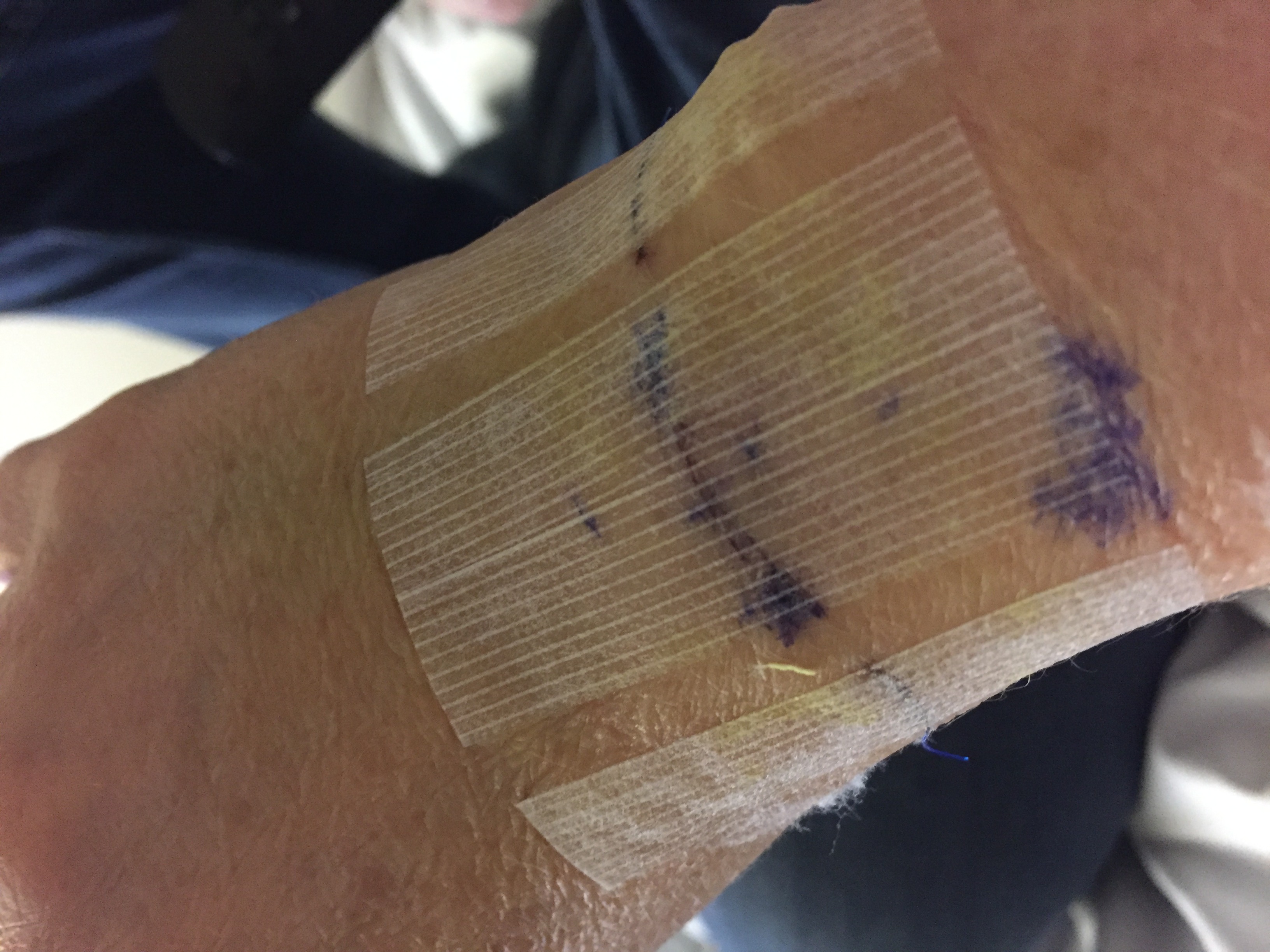 Ganglion Cyst Removal Excision Recovery Pictures Jenny Smith Ganglion Cyst Removal Excision Recovery Pictures Jenny Smith
