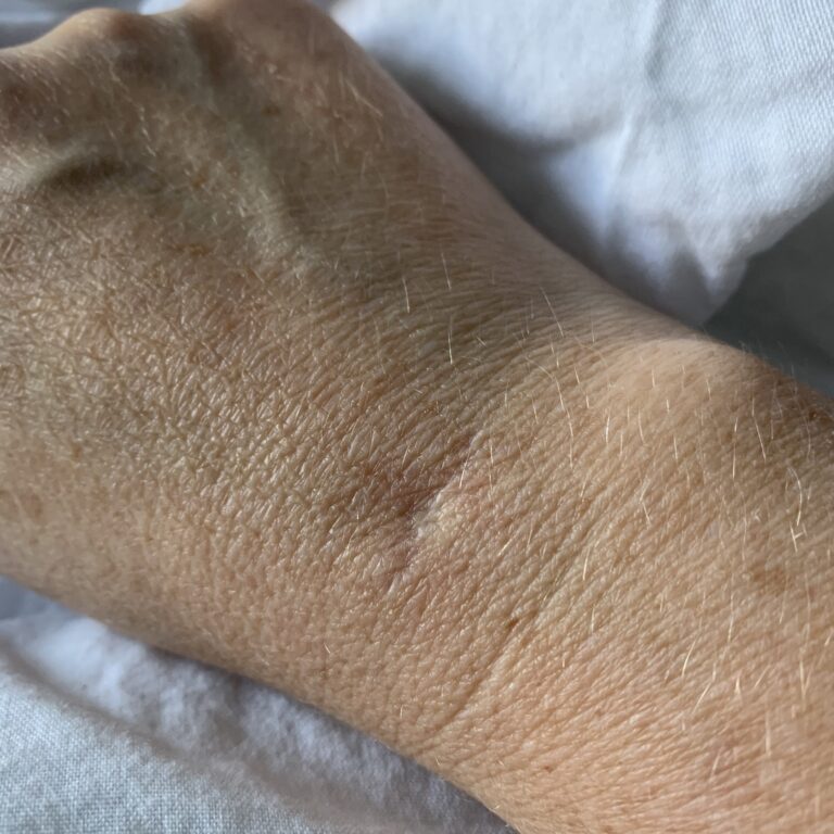Ganglion Cyst Removal / Excision Recovery Pictures - Jenny Smith